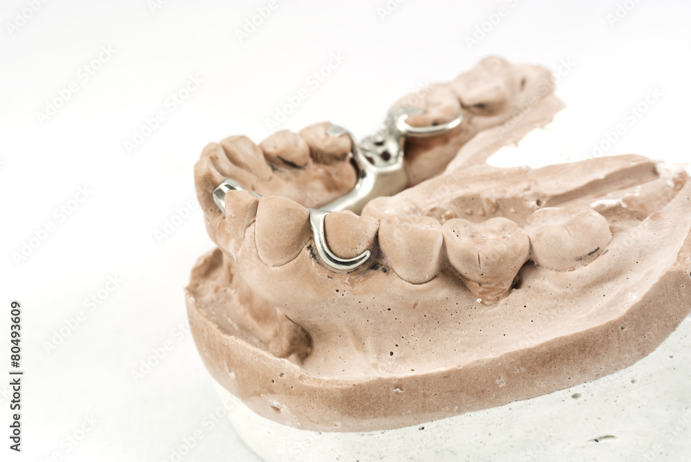 Dental cast with metal framework for partial denture Stock-Foto | Adobe ...