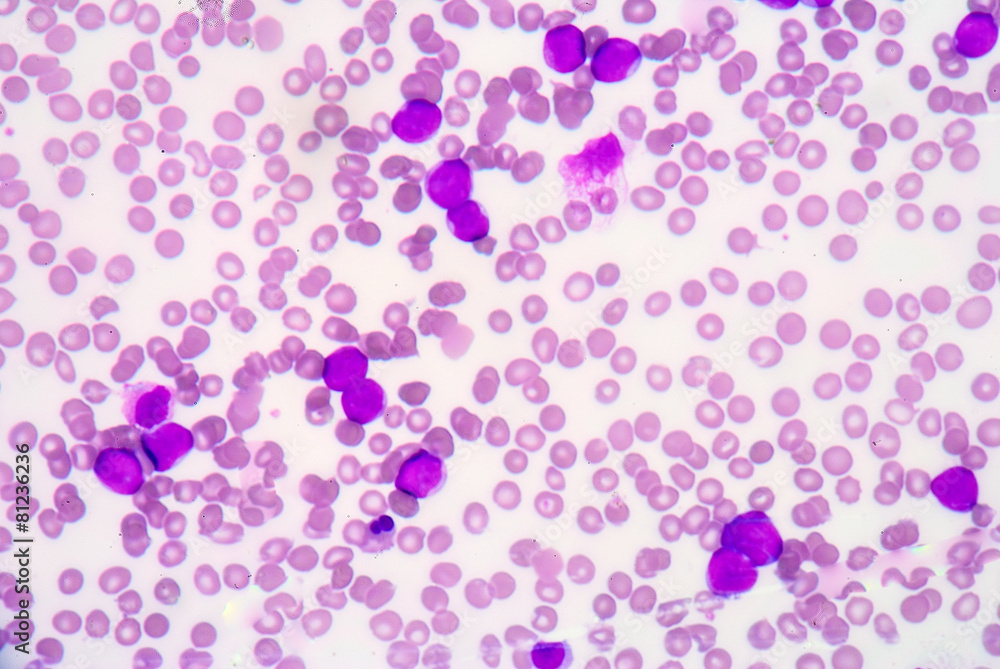 A blood smear is often used as a follow-up test to abnormal resu Stock ...