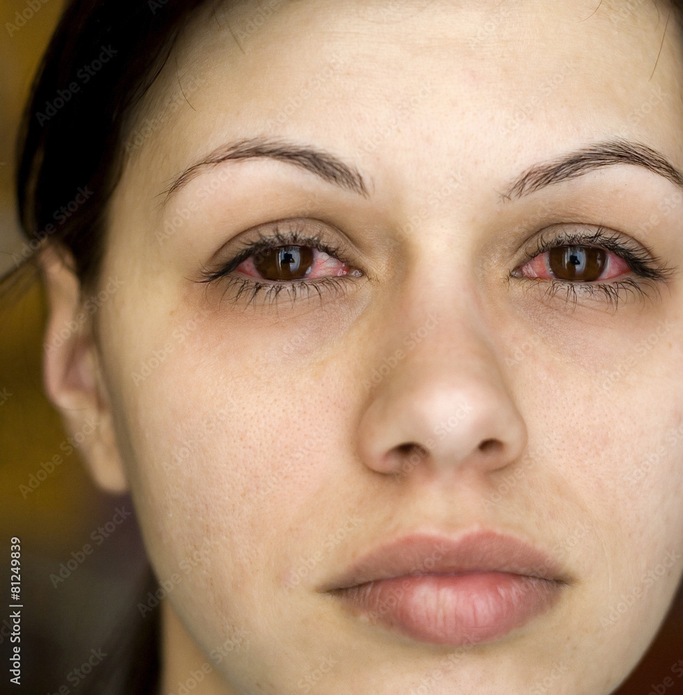 Sick women's eyes foto de Stock | Adobe Stock