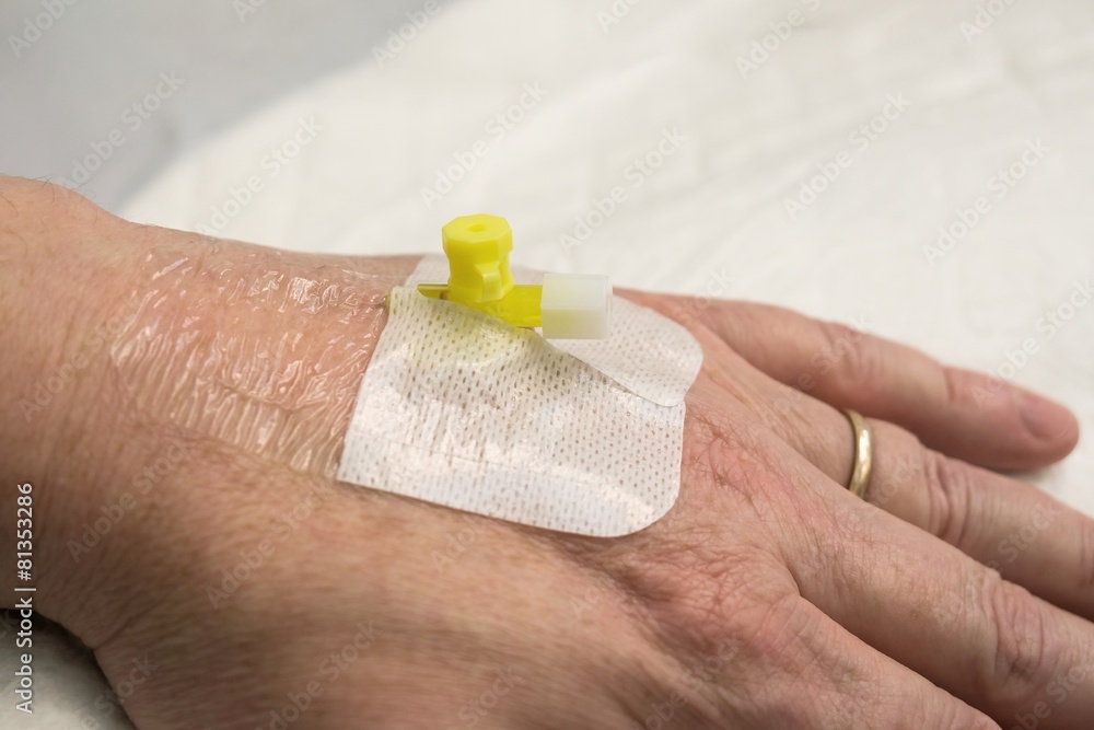 Peripheral venous catheter ready for infusion Stock Photo | Adobe Stock