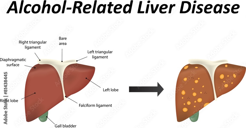 Alcohol Related Liver Disease Illustration Stock Illustration | Adobe Stock
