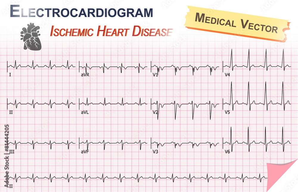 Electrocardiogram ( ECG , EKG ) of Ischemic Heart Disease Stock Vector ...