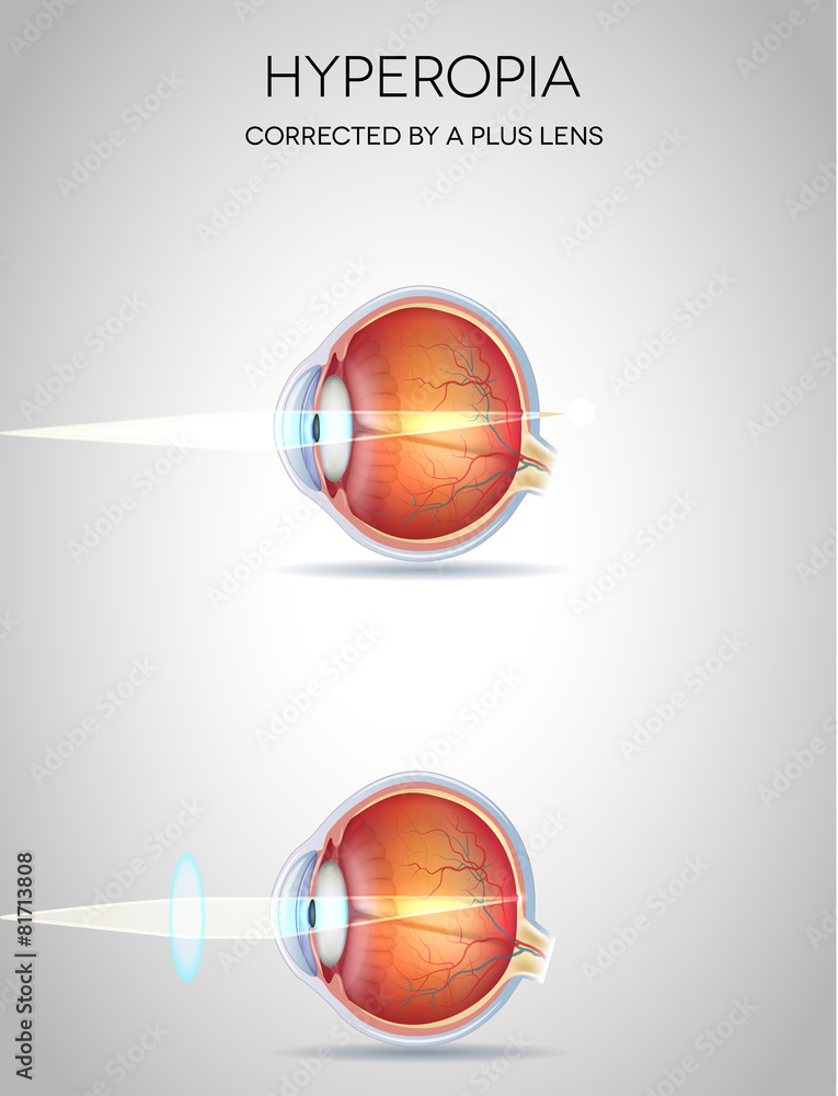 Hyperopia and Hyperopia corrected by a plus lens. Eye vision dis Stock ...