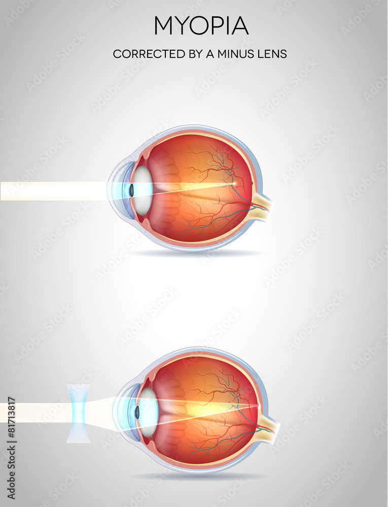 Myopia and myopia corrected by a minus lens. Eye vision disorder Stock ...
