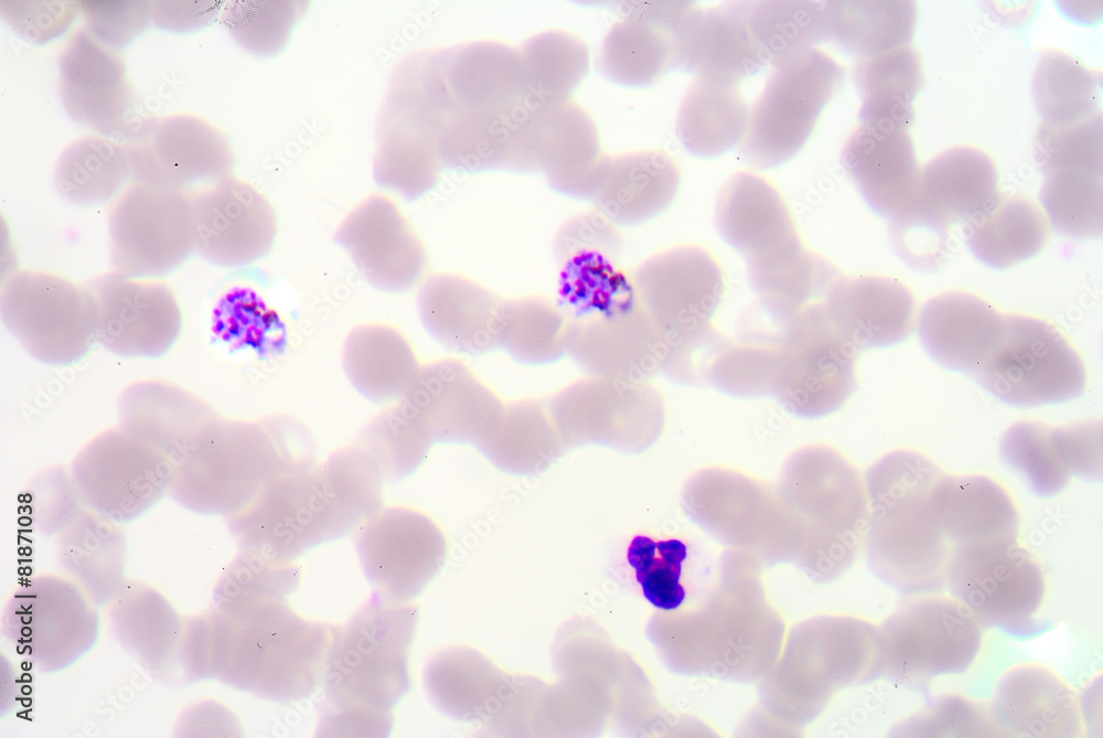 malaria blood smear pictures Stock Photo | Adobe Stock