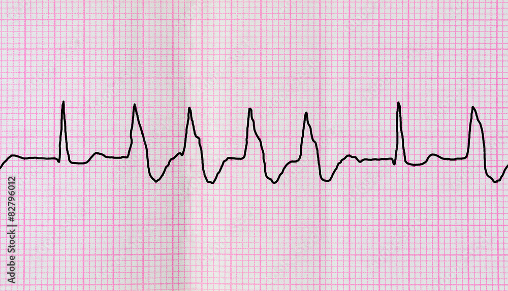 Tape ECG with group ventricular extrasystoles Stock Photo | Adobe Stock