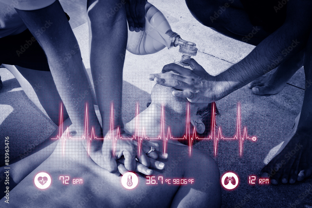 Cardiopulmonary resuscitation (CPR) concept. Graphics. Stock Photo ...
