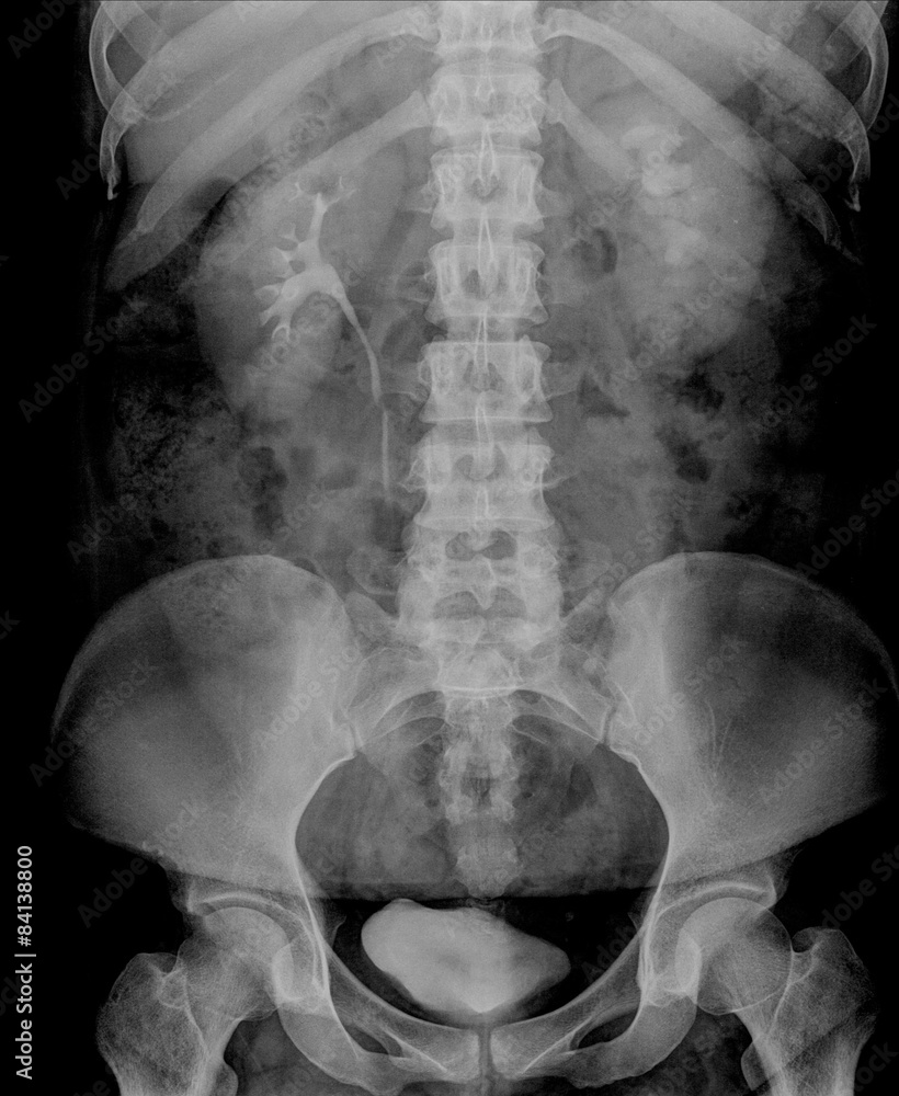 Film IVP, 10 minutes after injection of contrast media, of a lymphoma ...