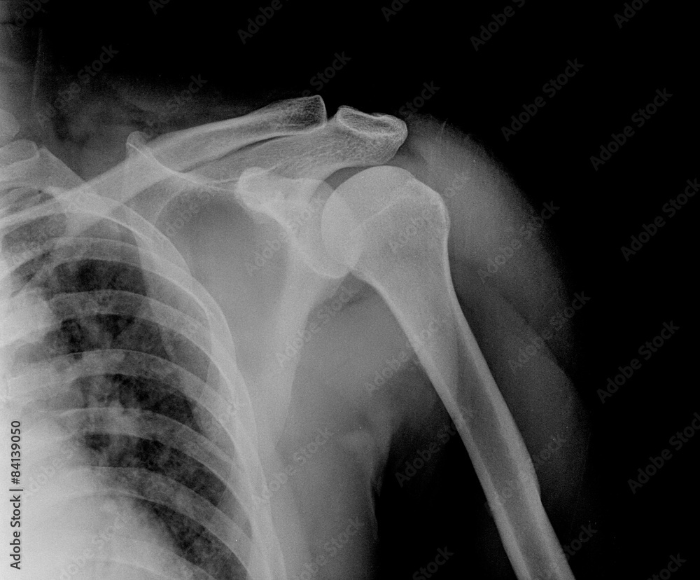 shoulder bone on x-ray, orthopedic view Stock Photo | Adobe Stock