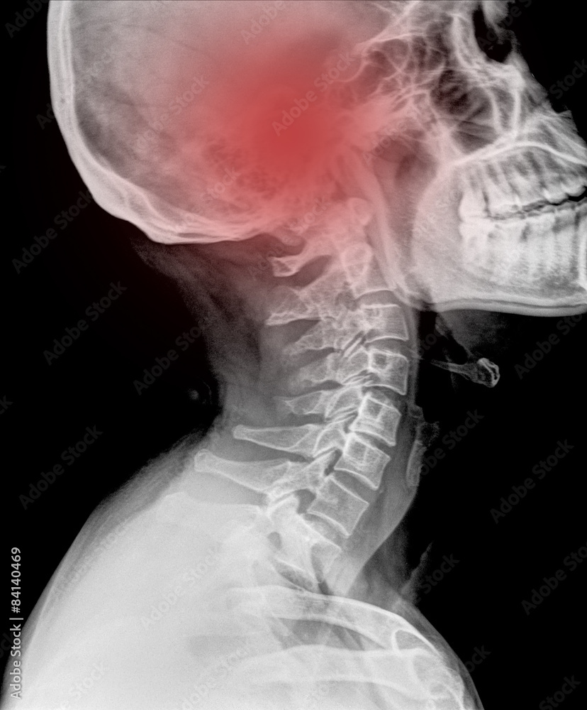 X Ray Head Injury