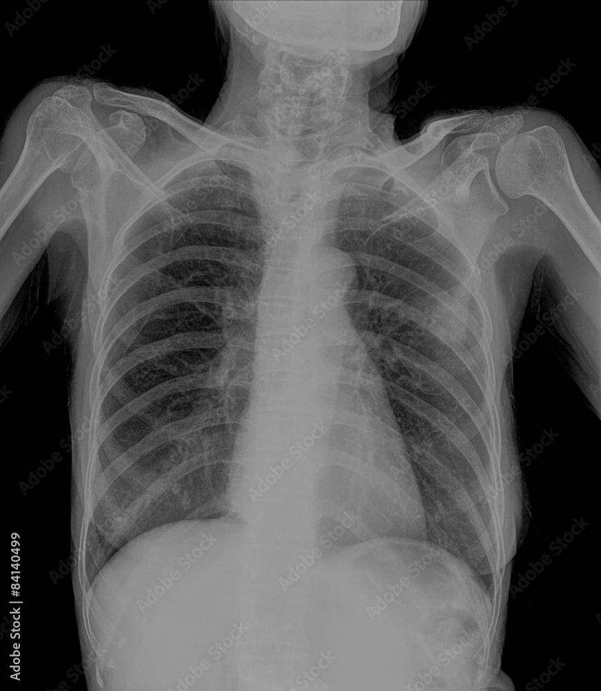 X-Ray Image Of Human Chest for a medical diagnosis Stock Photo | Adobe ...