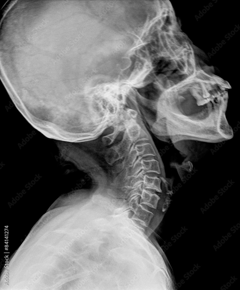 MRI - Magnetic Resonance Imaging of Spinal Column and Skull Head Stock ...