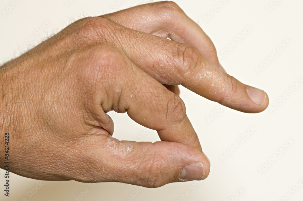 Neurodermitis Hand 607 Stock-Foto | Adobe Stock