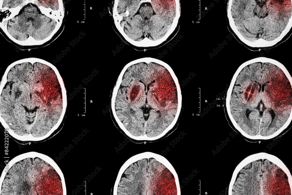 Ischemic stroke : ( CT of brain show cerebral infarction at left ...