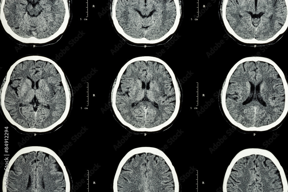 CT scan of brain show normal brain ( Neurological background )CT scan ...