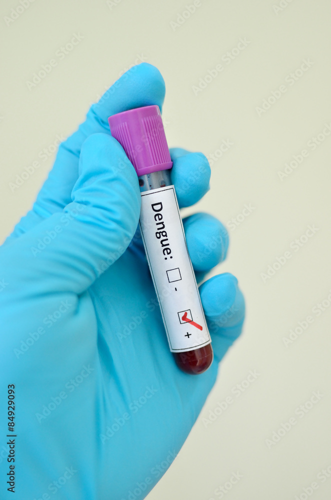 Blood sample with Dengue virus positive Stock Photo | Adobe Stock