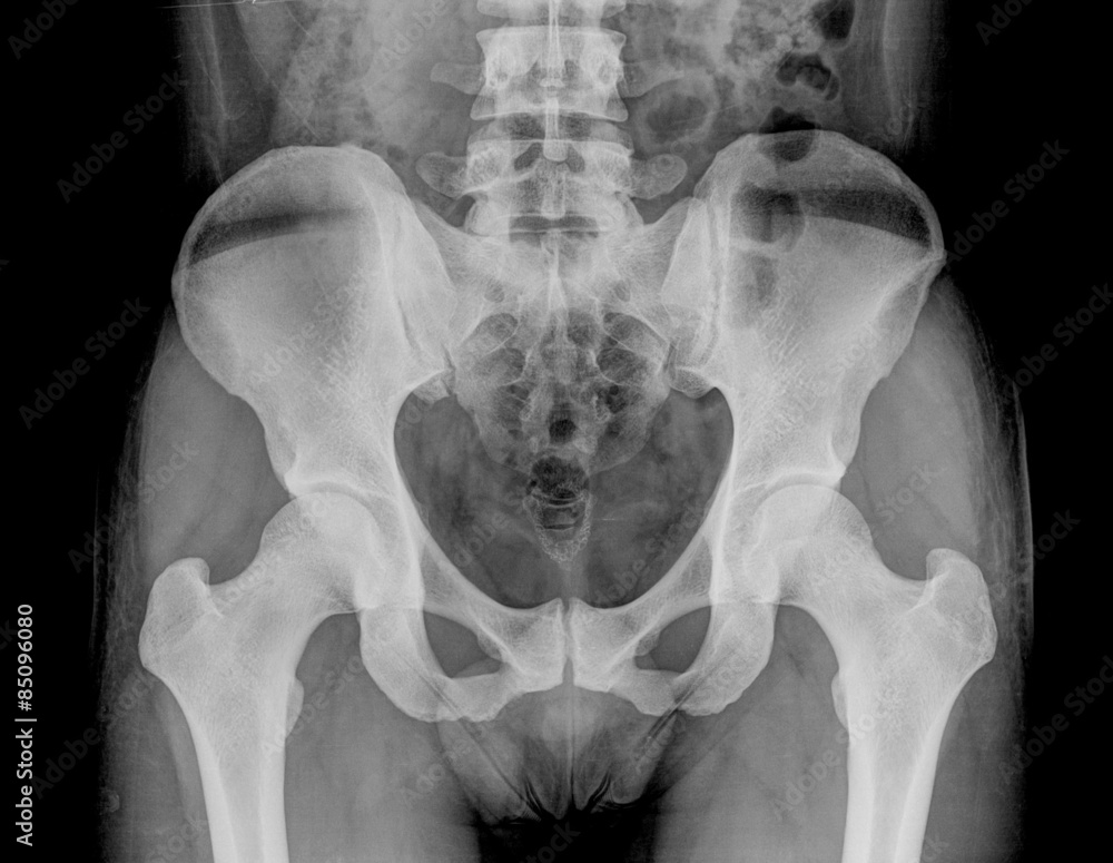 Rontgen picture of male pelvis Stock Photo | Adobe Stock