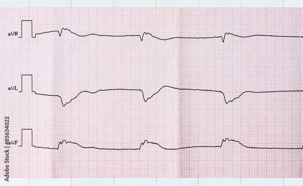 Tape ECG after clinical death and a successful resuscitation Stock ...