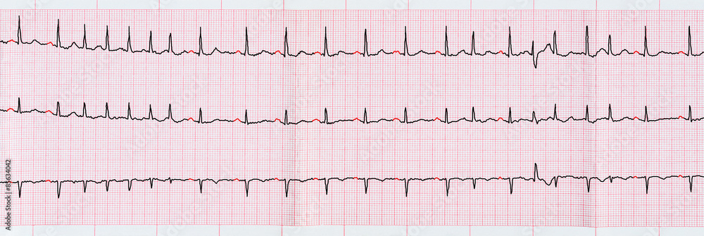 Poster ECG with supraventricular premature beats and short paroxysms of ...