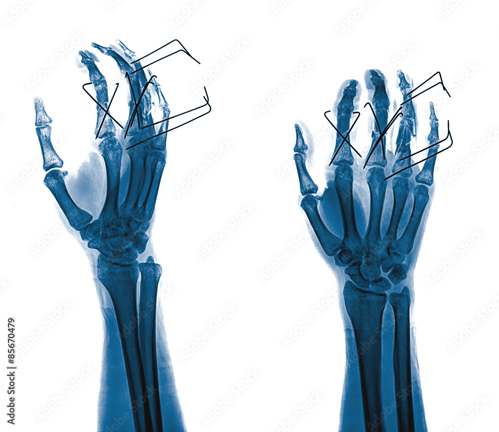 Photo & Art Print hands x-rays image showing wire fixation ring finger ...