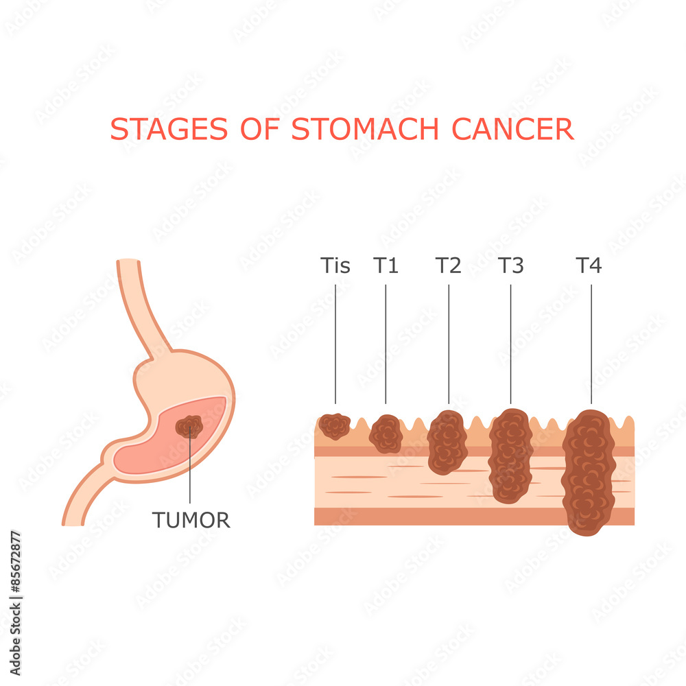stomach cancer stages, human gastric tumor anatomy, digestive system ...