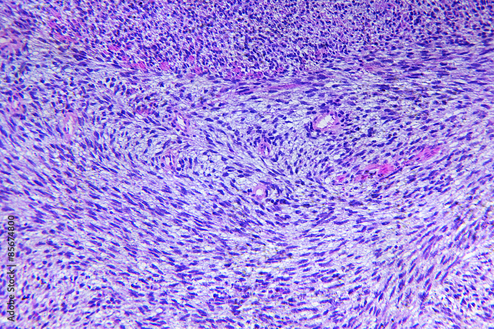 Fibrosarcoma of a human Stock Photo | Adobe Stock