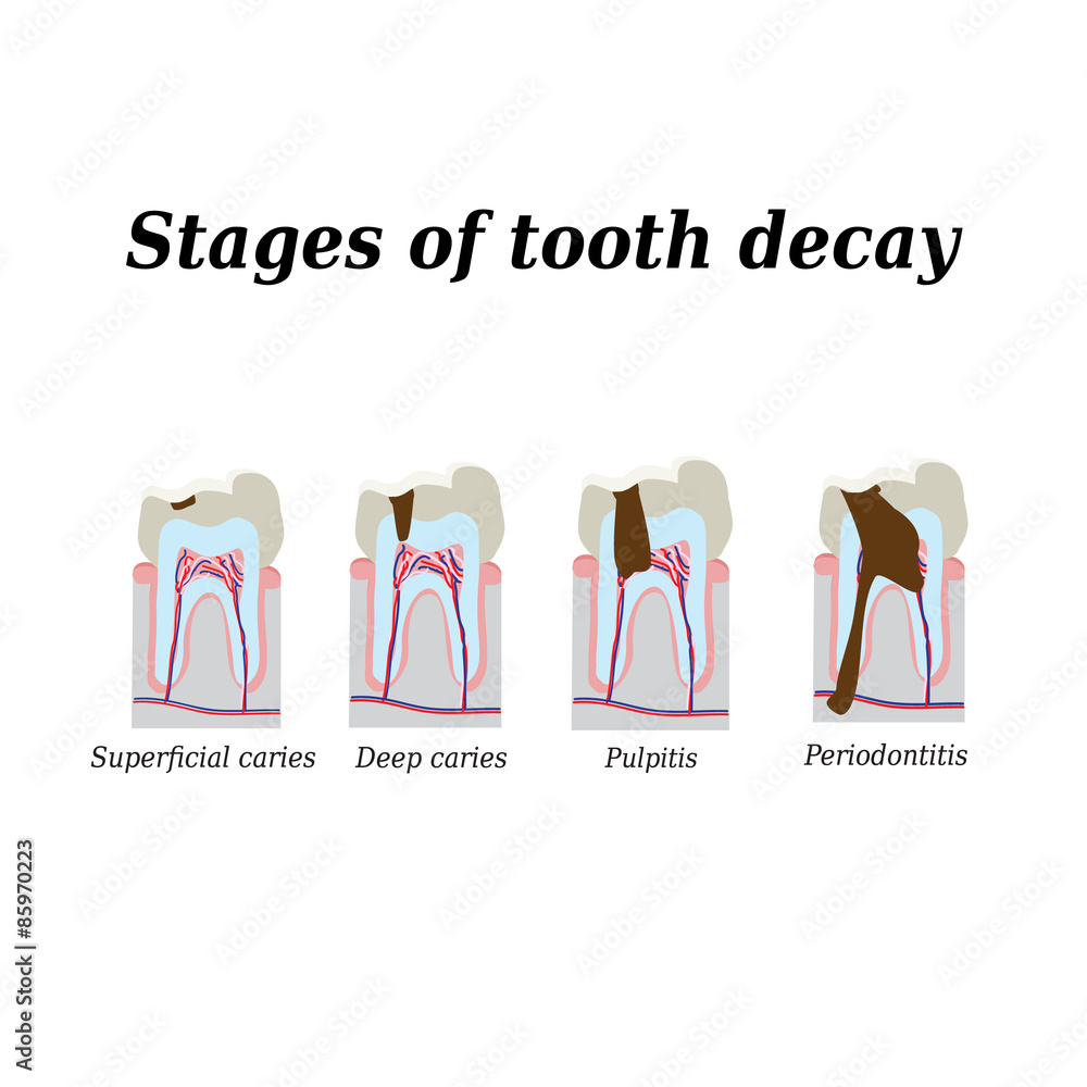 Stages of development of dental caries. Vector illustration on Stock ...