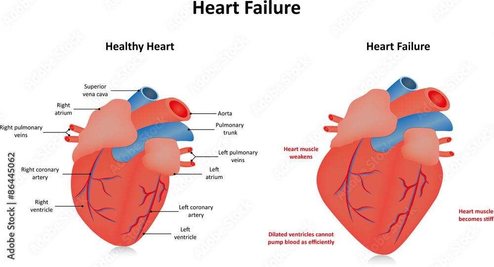 Heart Failure Labeled Diagram Stock Vector | Adobe Stock