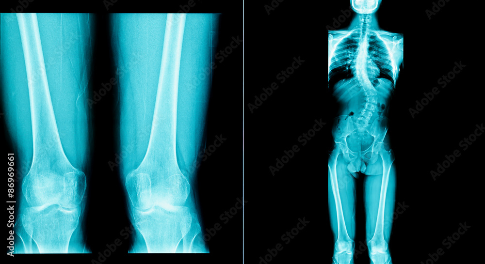 x-ray image of human have a long bone body Stock Illustration | Adobe Stock