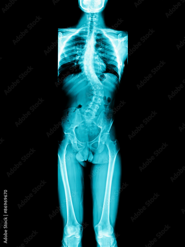 .x-ray image of human have a long bone body Stock Illustration | Adobe ...