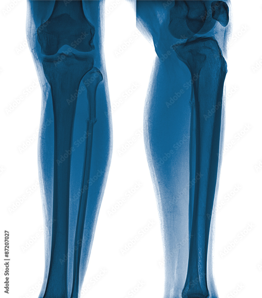 X-ray film of proximal tibia and intra articular fracture Stock Photo ...