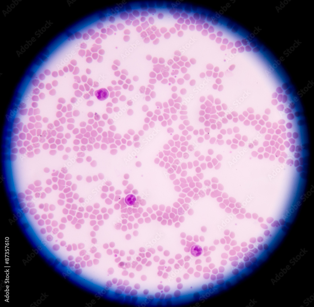 White blood cells of a human, photomicrograph panorama as seen u Stock ...