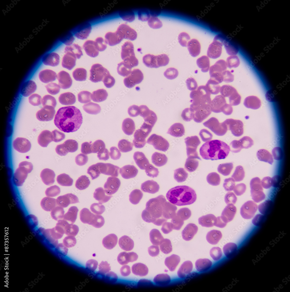 White blood cells of a human, photomicrograph panorama as seen u Stock ...