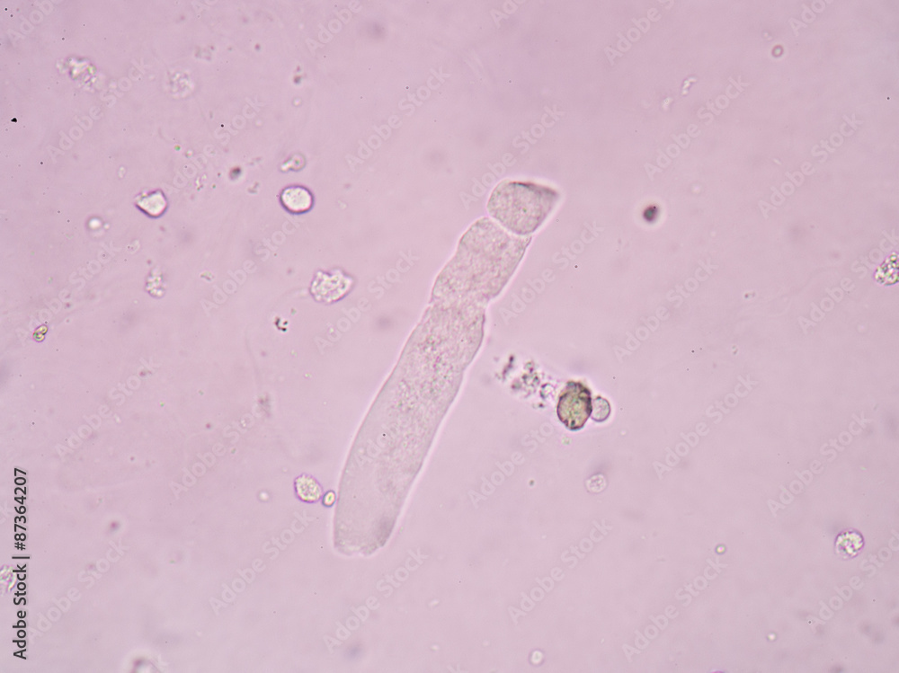 Hyaline Cast In Urine
