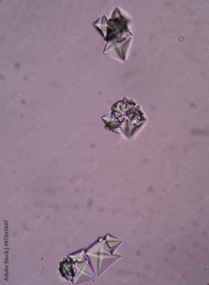 calcium oxalate crystal in urine analysis. Stock Photo | Adobe Stock