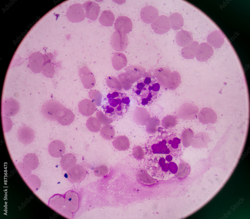 Foto de Abnormal neutrophil in pleural fluid smear. do Stock | Adobe Stock