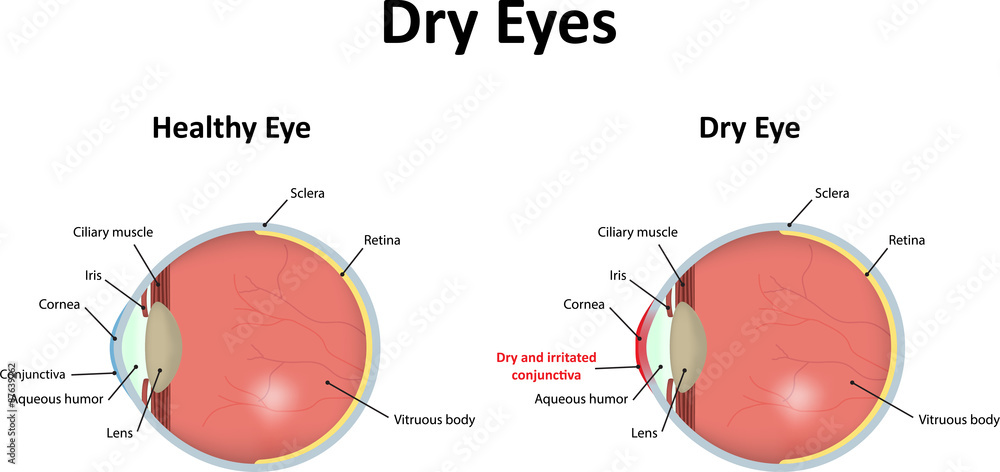 Dry Eyes Illustration Stock Vector | Adobe Stock