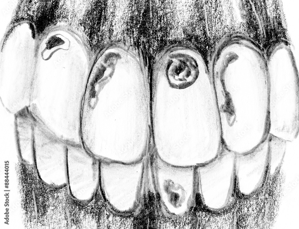 Tooth decay, Cavities are seen at the base of several teeth,artwork ...
