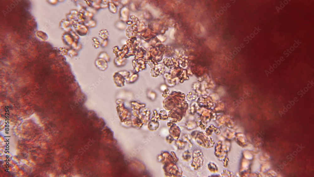 Damaged Blood Cells Seen at 800x Magnification. Stock Video | Adobe Stock