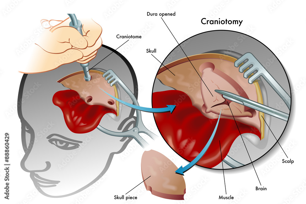 craniotomia Stock Vector | Adobe Stock
