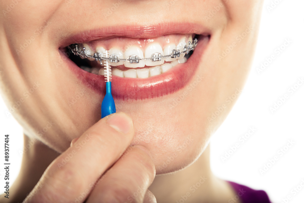 Beautiful smiling girl with retainer for teeth. Stock Photo | Adobe Stock