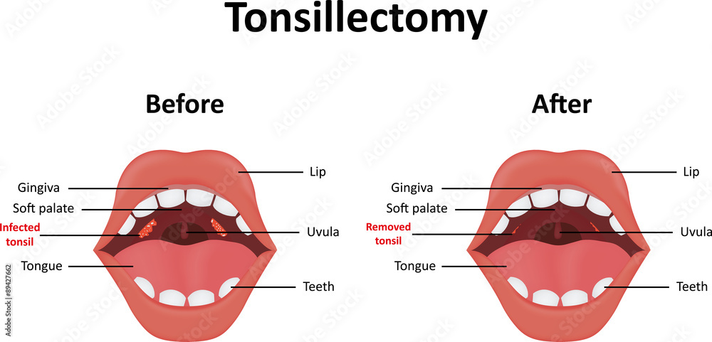 Tonsillectomy Illustration Stock Vector | Adobe Stock