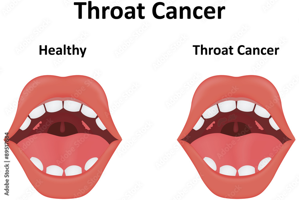 Throat Cancer Illustration Stock Vector | Adobe Stock
