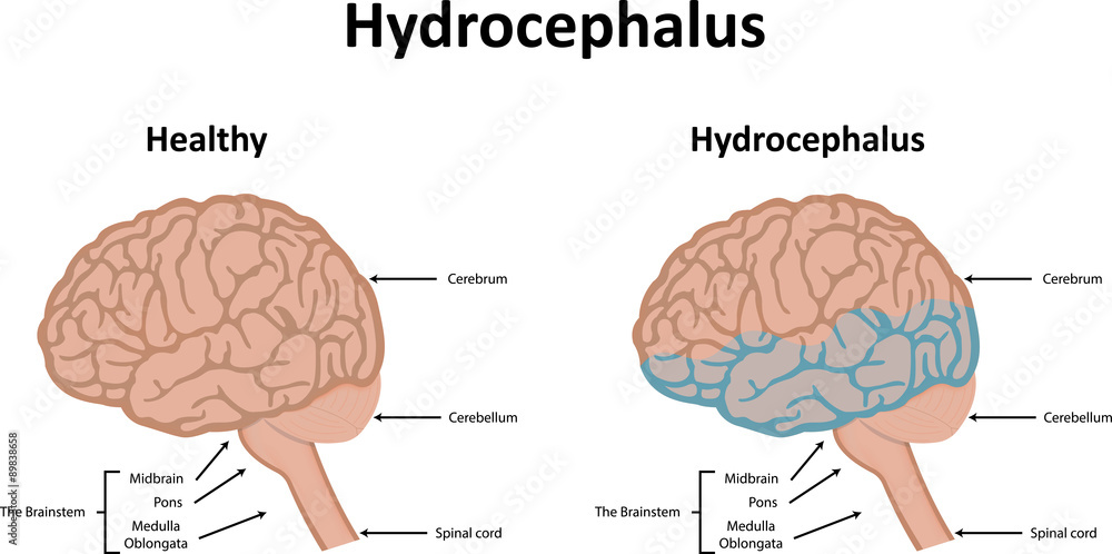 Hydrocephalus Illustration Stock Illustration | Adobe Stock