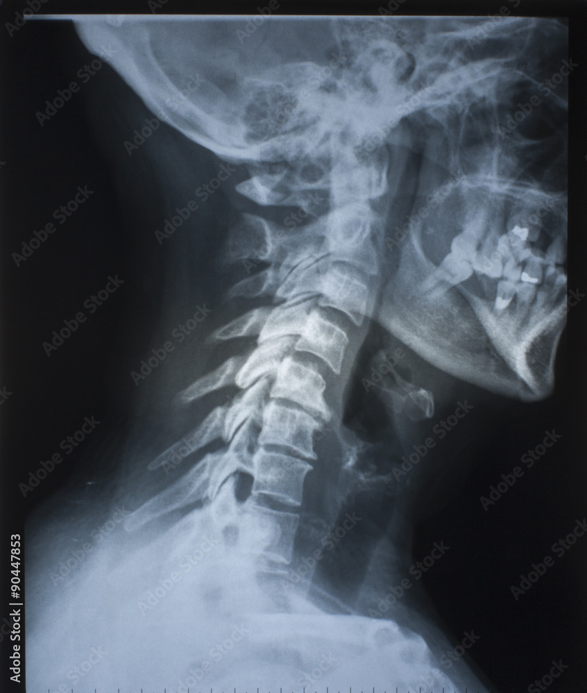 radio graphs skull and cervical vertebra Stock Photo | Adobe Stock