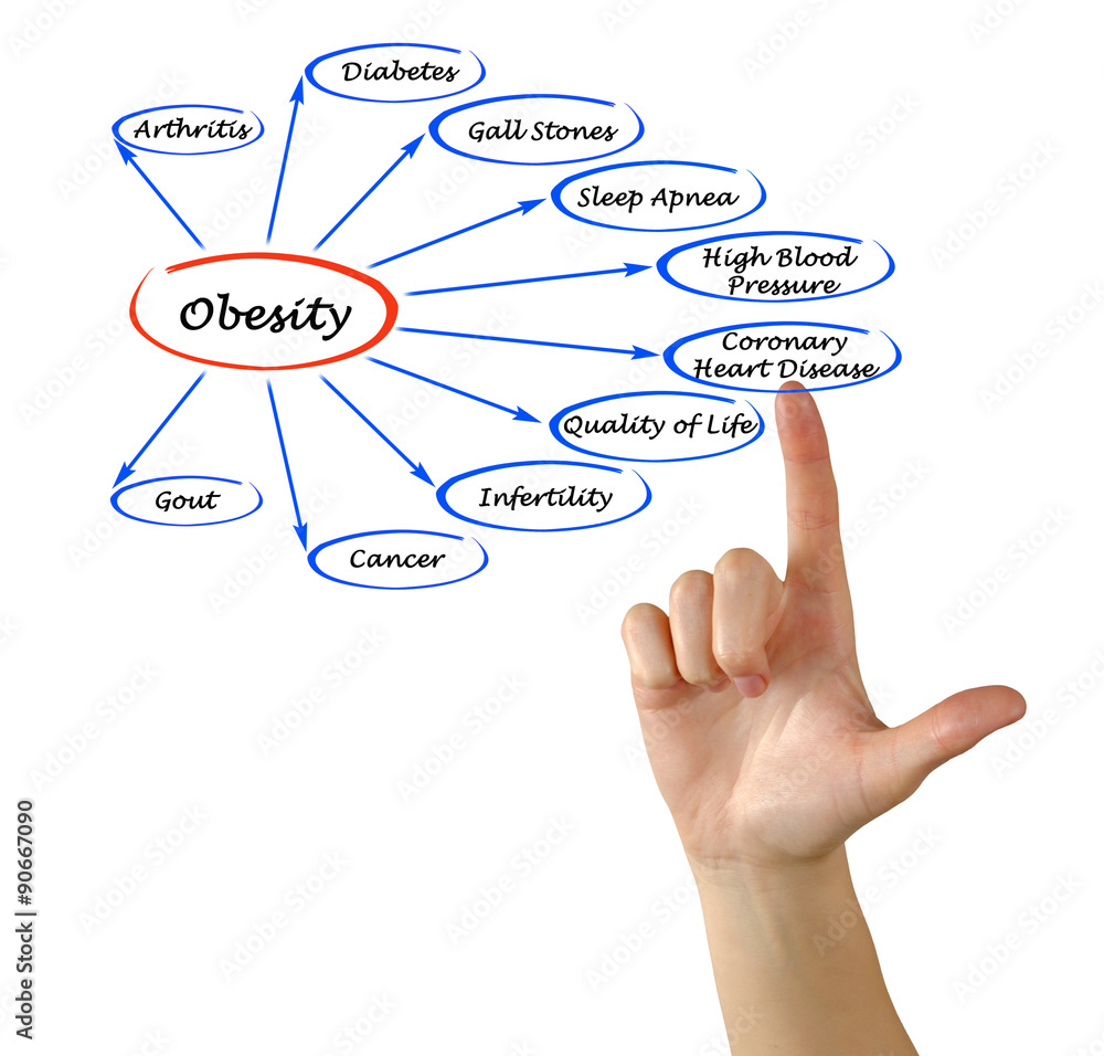 Diagram of Obesity Stock Illustration | Adobe Stock