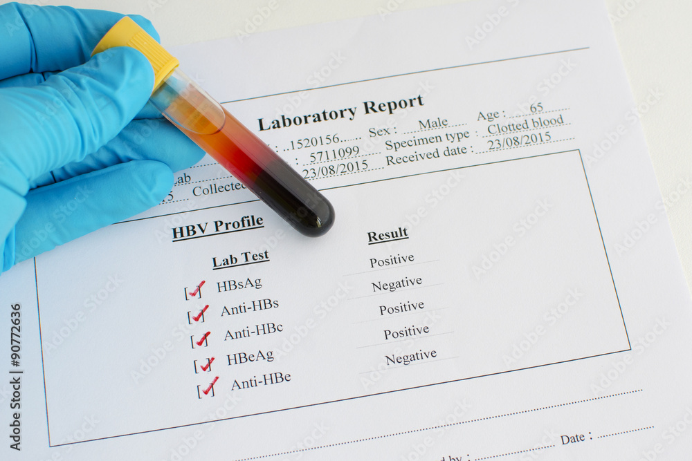 Hepatitis B Blood Tests