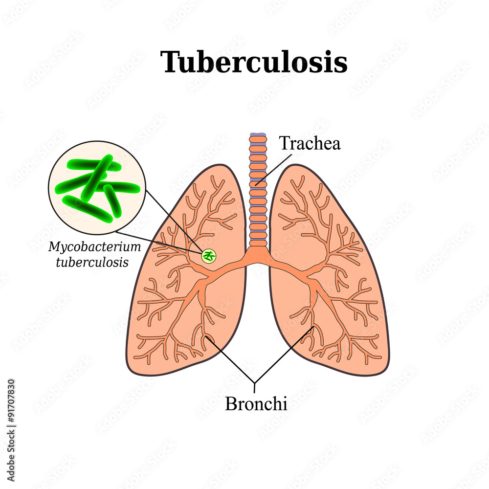 Mycobacterium Tuberculosis Labelled Diagram