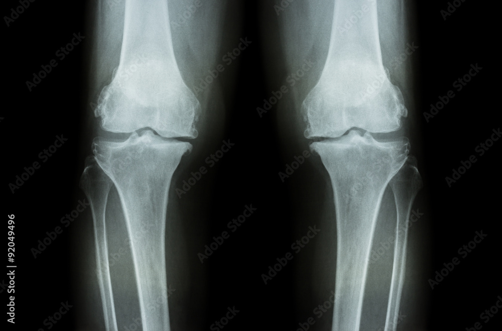 Osteoarthritis Knee ( OA Knee ). Film x-ray both knee ( front view ...