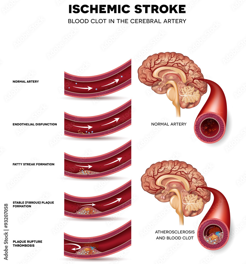 Blood clot formation in the cerebral artery Stock Vector | Adobe Stock